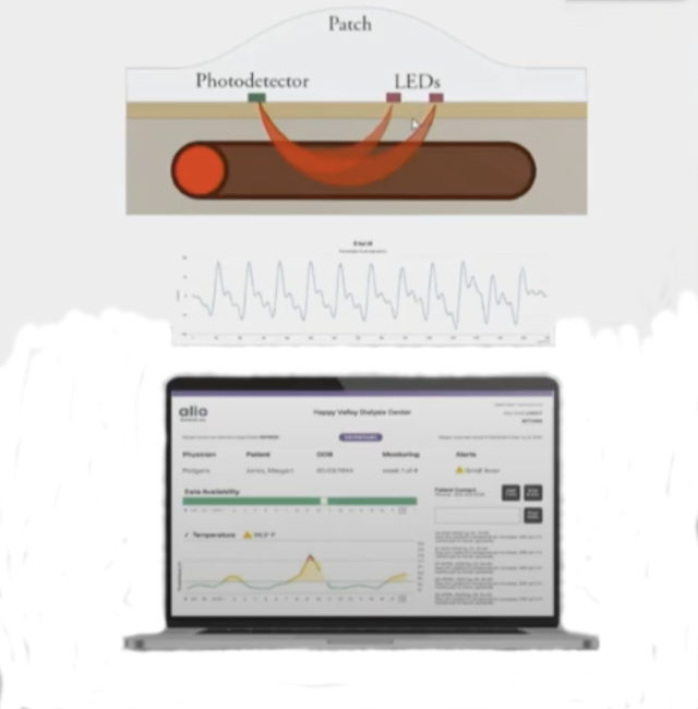 Wearable device for AV fistula remote monitoring shows promise—but ...