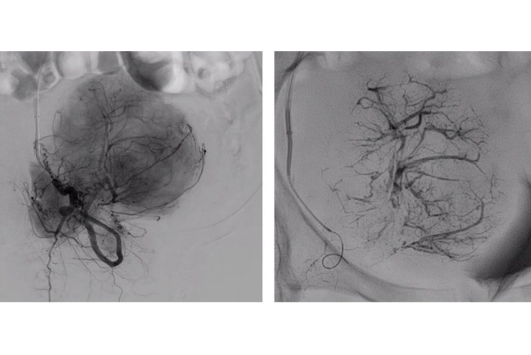 New liquid embolic multicentre trial successfully enrols final patient