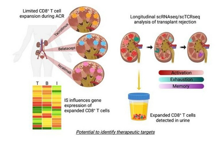 New urine test could explain kidney transplant rejections New urine test could explain kidney transplant rejections