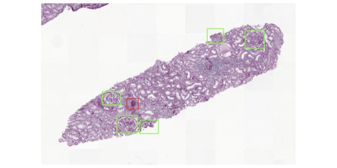 Aiosyn releases AI kidney suite to advance renal disease research