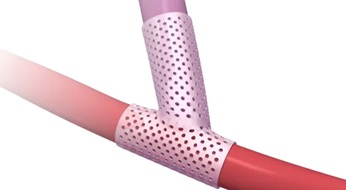 First subjects enrolled in US clinical trial for VenoStent - Renal ...