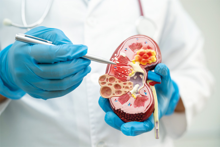 New technique detects novel biomarkers for kidney diseases with ...