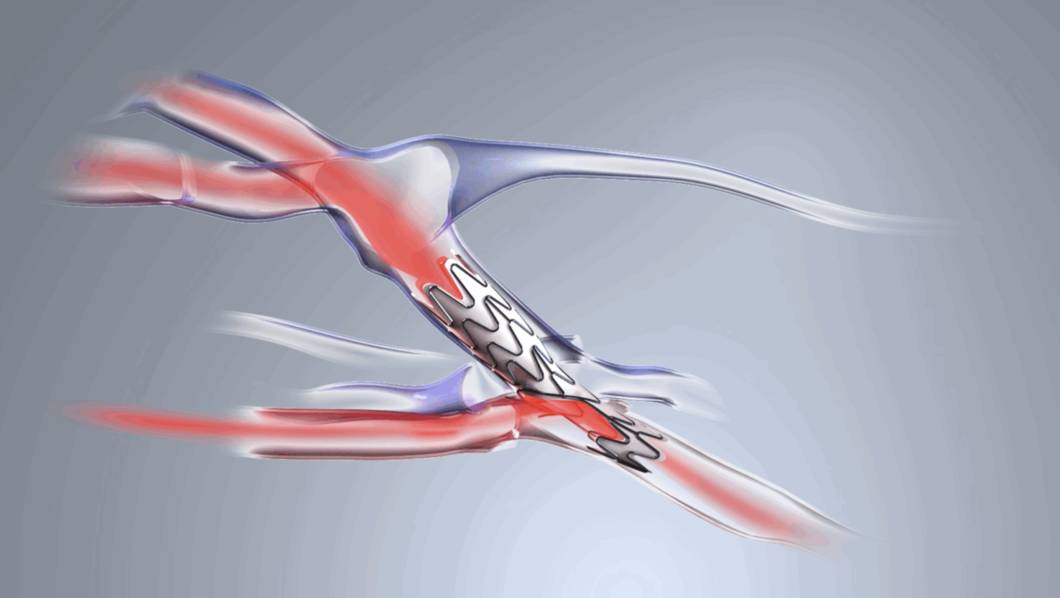 Implant-based AVF system “achieves consistent physiologic maturation ...