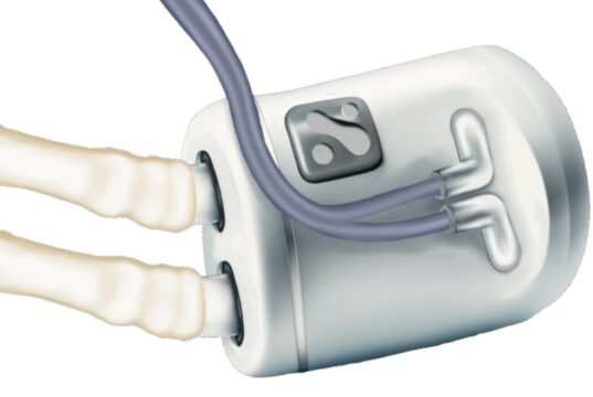 US FDA grants breakthrough designation for implantable dialysis system ...